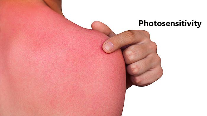 Can You Be Allergic To Water Aquagenic Urticaria Techietonics